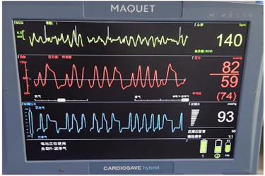ECMO辅助下急诊PCI治疗急性心梗1例 - 中国临床案例成果数据库