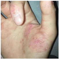 SAPHO综合征1例 - 中国临床案例成果数据库