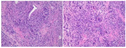 妊娠合并宫颈大细胞神经内分泌癌伴抗利尿激素分泌紊乱1例 - 中国临床案例成果数据库