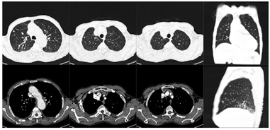 Caplan综合征1例 - 中国临床案例成果数据库