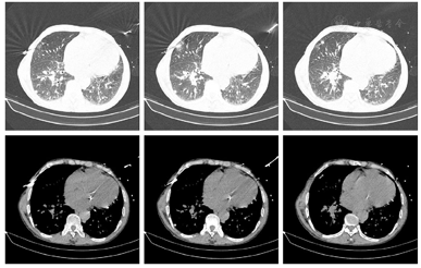 Caplan综合征1例 - 中国临床案例成果数据库