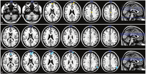 Aberrant Functional Connectivity Patterns of Default Mode Network May Play a Key Role in the ...
