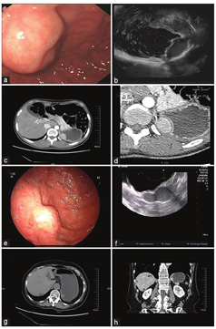 Accessory Spleen Presenting as a Submucosal Lesion on Stomach Wall ...