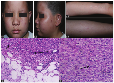 Multibacillary Leprosy in a Child