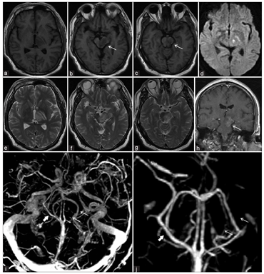 Unilateral Isolated Basal Vein Thrombosis Associated with Deep Cerebral ...