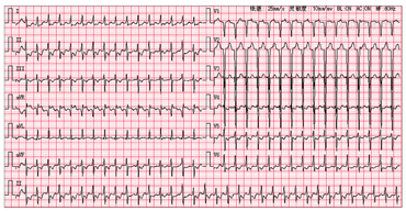 Extracorporeal Membrane Oxygenation Support for Incessant ...