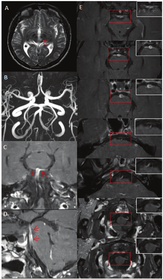 Fabry disease with acute cerebral infarction onset in a young patient