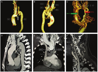 Interrupted aortic arch with multiple vascular malformations