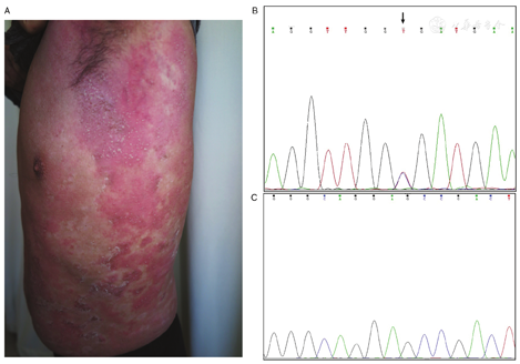 Recurrent generalized pustular psoriasis possibly triggered by apremilast