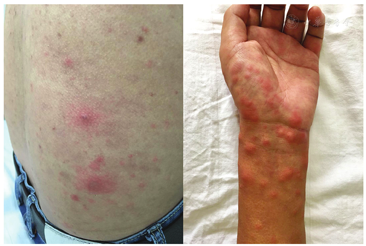 Recurrent fever and cutaneous nodules: leprosy masquerading as anti ...