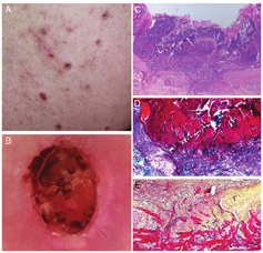 Acquired reactive perforating collagenosis
