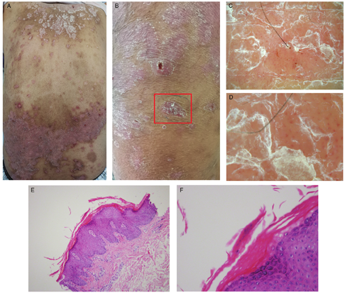 Dermoscopic features of acutely exacerbated plaque psoriasis induced by ...