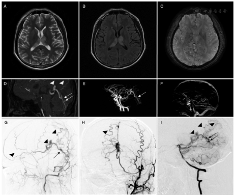 Bilateral thalamic lesions caused by a complex intracranial dural ...