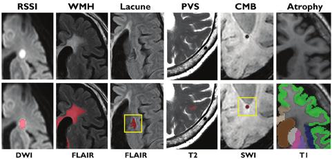 Magnetic resonance imaging manifestations of cerebral small vessel ...