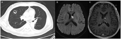 A report on pneumonia-induced ventriculitis with intraventricular abscess