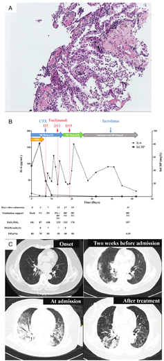 Successful treatment with tocilizumab in a patient with rapidly ...