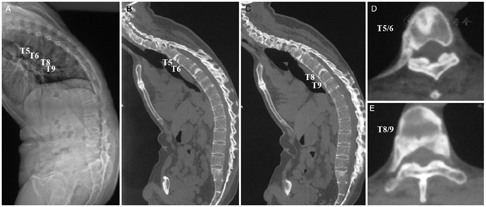 Occult Andersson lesions in patients with ankylosing spondylitis ...