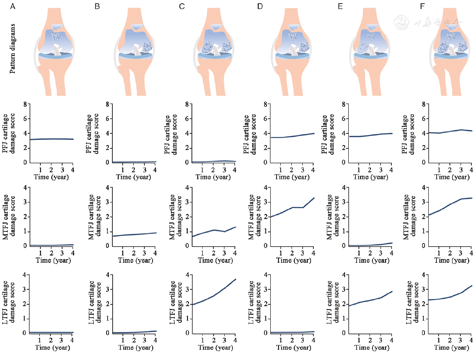 Trajectory and predictors of cartilage damage in three compartments of ...
