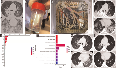 Diagnosis, treatment, and potential causative mutations of cryptogenic ...