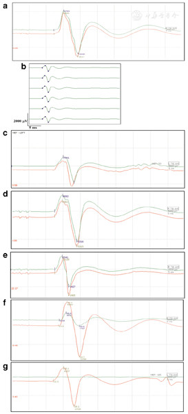 Transcranial electrical stimulation motorevoked potentials in a spinal ...