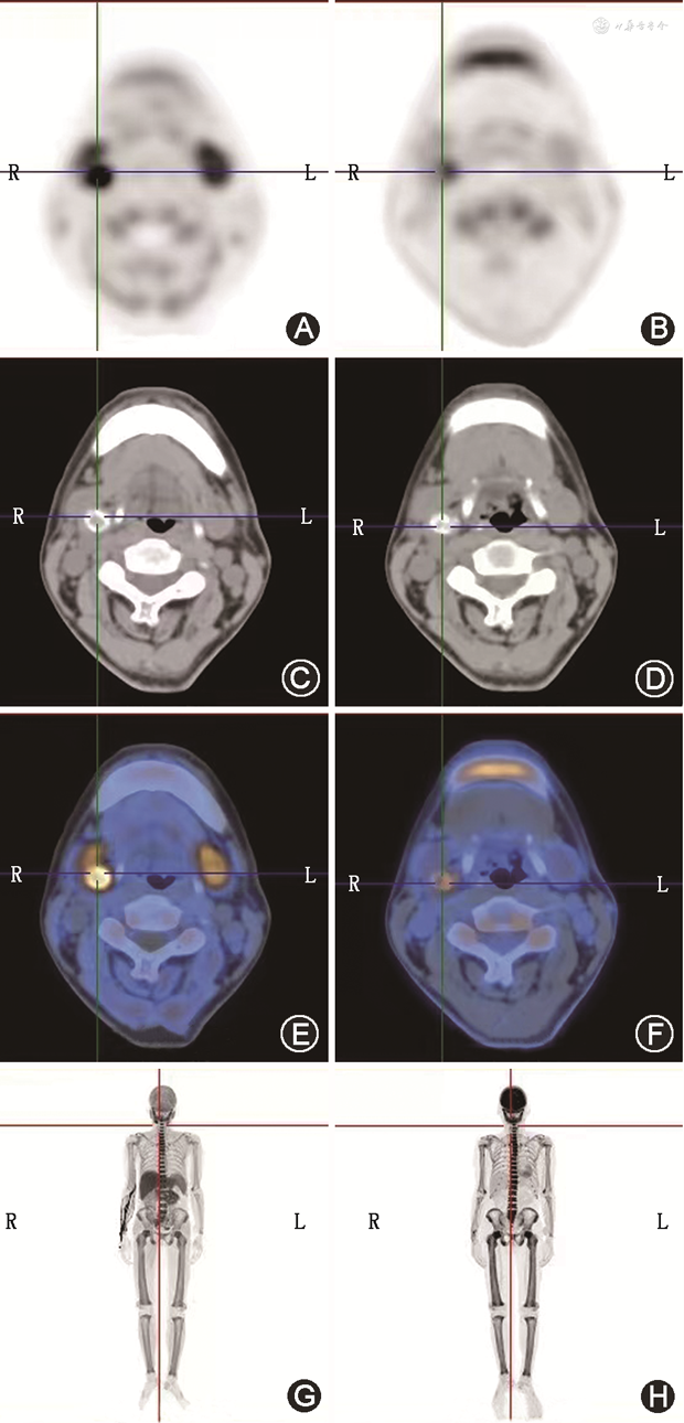 99Tcm-MIBI SPECT/CT阴性的颌下异位甲状旁腺腺瘤1例 - 中华耳鼻咽喉头颈外科杂志