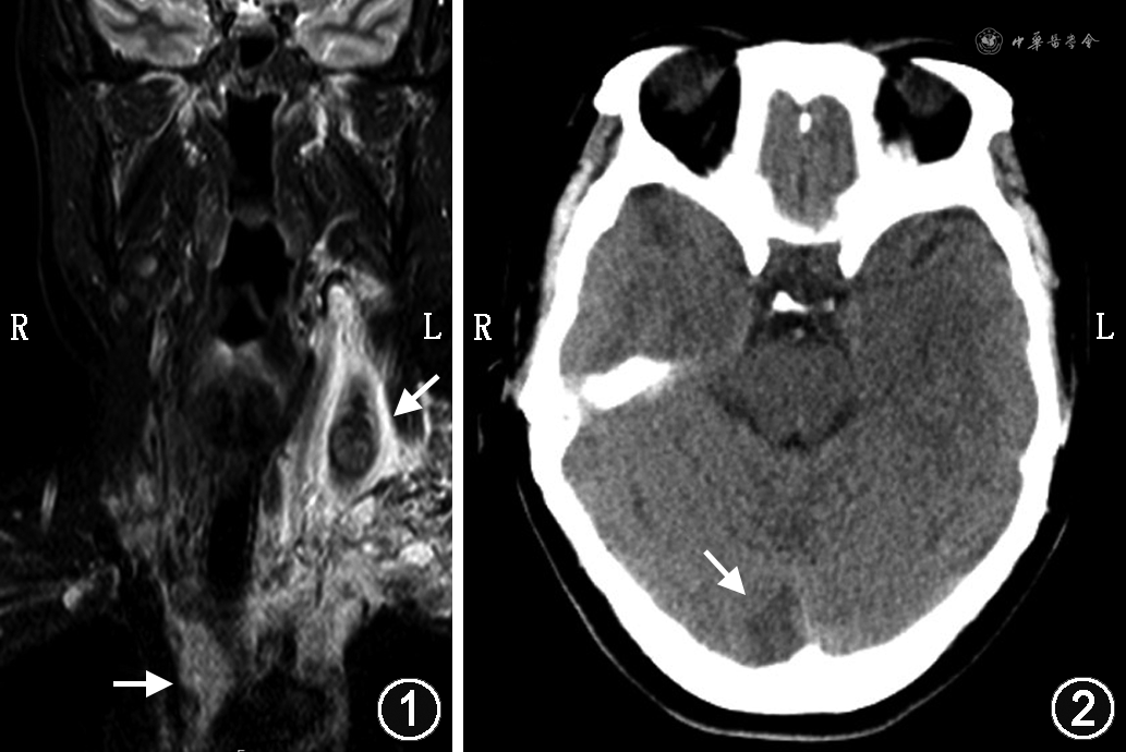 Lemierre综合征3例 - 中华耳鼻咽喉头颈外科杂志