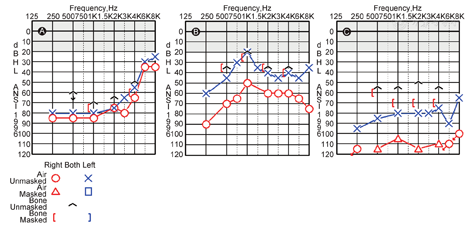 Scoping review of cochlear implantation in Susac’s syndrome
