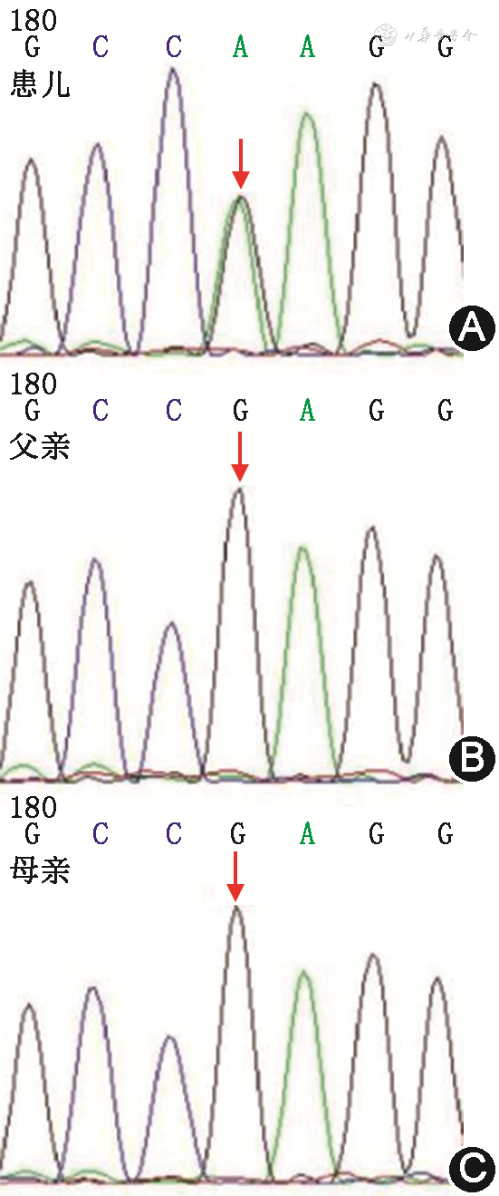 STAT3基因新发突变致儿童慢性腹泻1例