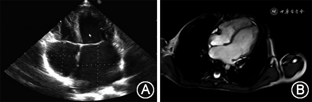 TPM1基因新发突变相关限制型心肌病1例