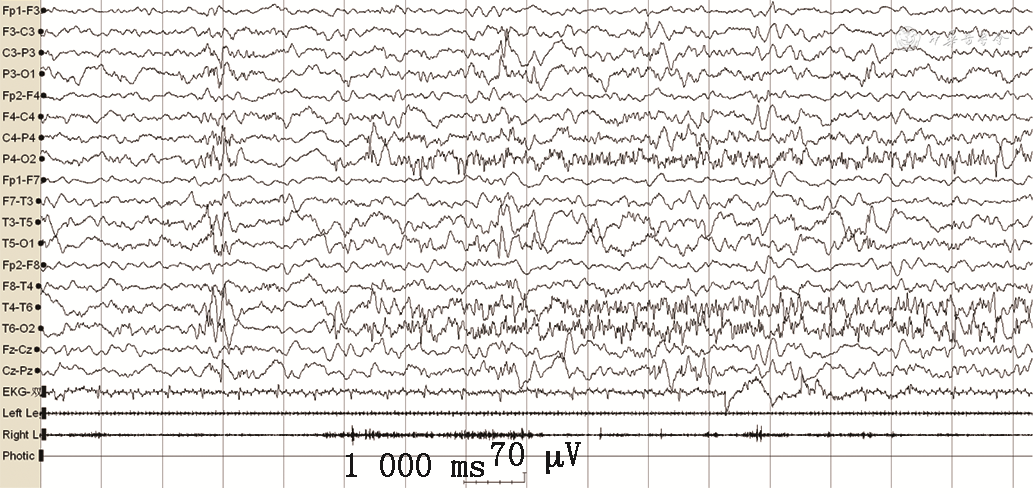 婴儿抗AMPA2受体脑炎1例 - 中华儿科杂志