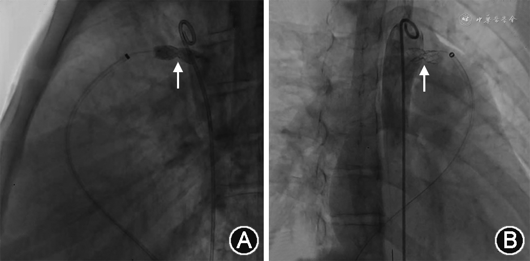 经导管Potts分流术治疗儿童重度肺动脉高压1例
