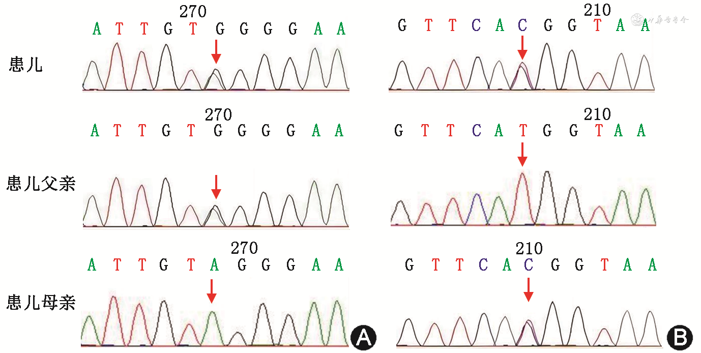 以孤立性扩张型心肌病起病的晚发型丙酸血症1例 - 中华儿科杂志