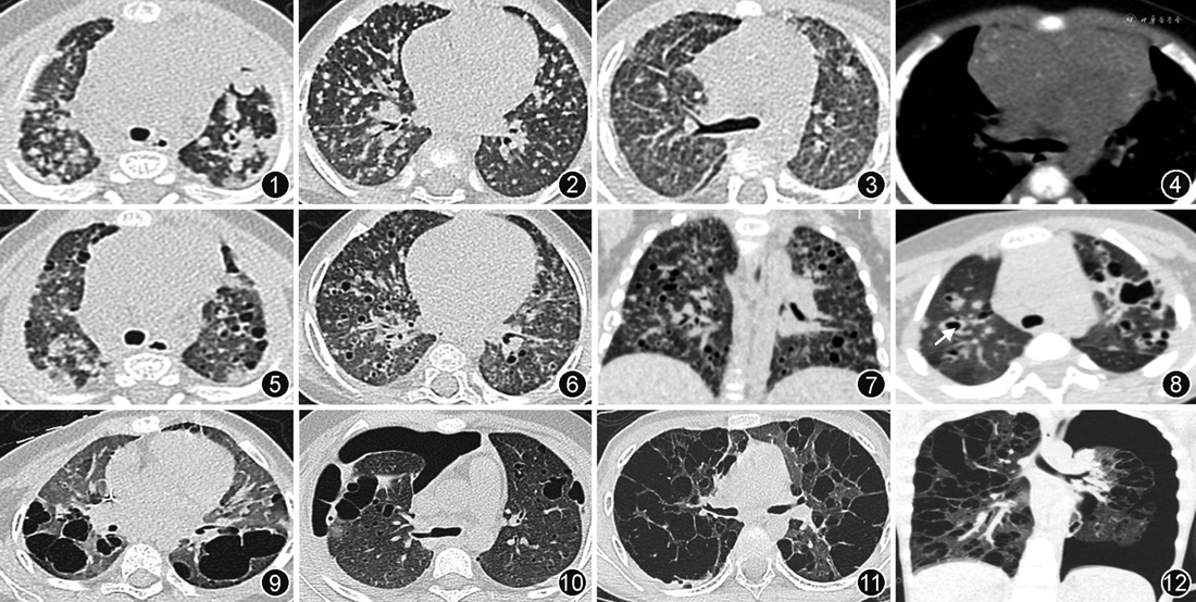 儿童肺朗格汉斯细胞组织细胞增生症的影像诊断及鉴别诊断 - 中华放射学杂志