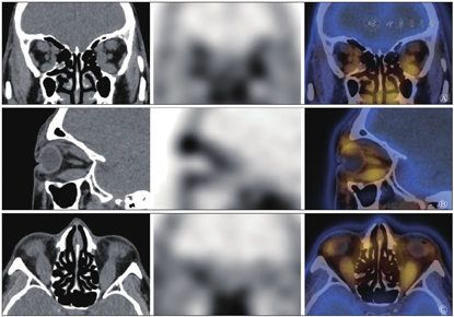 99Tcm-DTPA SPECT/CT在二例甲状腺相关性眼病患者活动期评估中的应用及文献复习 - 国际放射医学核医学杂志