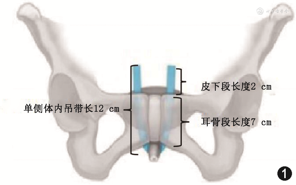 尿道中段悬吊带术后耻骨后吊带完整取出1例 - 中华妇产科杂志