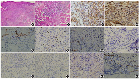 Cytokeratin-negative epithelioid sarcoma: a case report