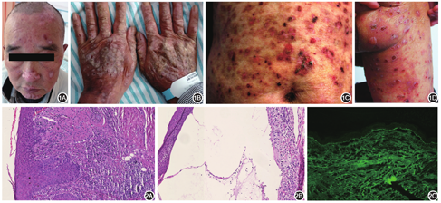Coexistence of chronic actinic dermatitis with bullous pemphigoid: a ...