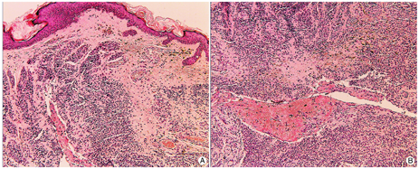 Targetoid Hemosiderotic Nevus