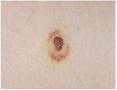 Targetoid Hemosiderotic Nevus
