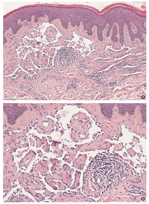 Retiform Hemangioendothelioma