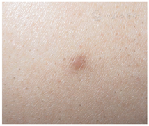 Retiform Hemangioendothelioma