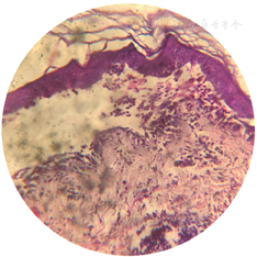 Cutaneous Myiasis in a Neglected Case of Pemphigus Vulgaris: A Case Report