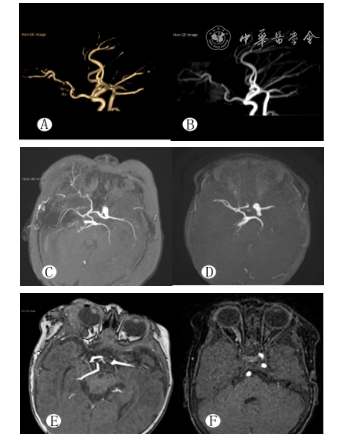 PHACE综合征1例 - 中国基层医药