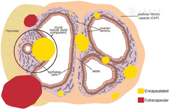 Update on mucinous cystic neoplasm of the pancreas: a narrative review