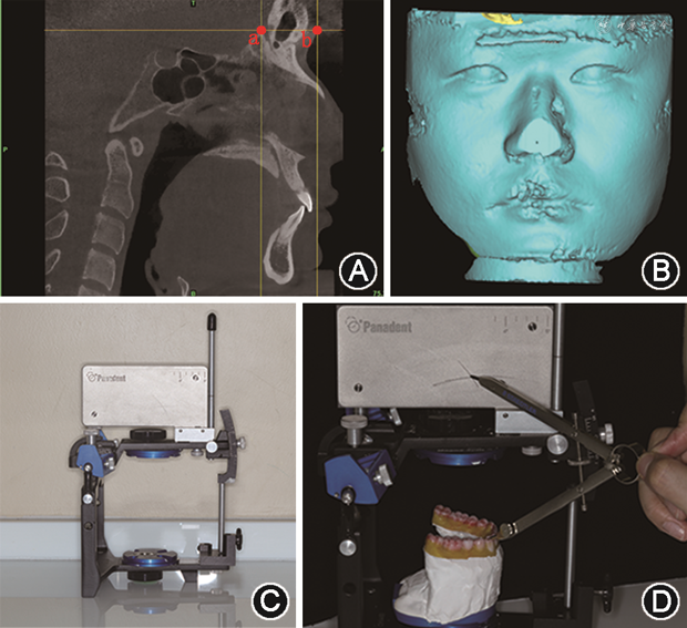 咬合平面分析仪辅助全口重度磨耗咬合重建1例 - 中华口腔医学杂志