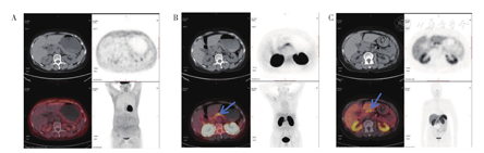 1例68Ga-Exendin-4 PET/CT及68Ga-DOTATATE PET/CT双阳性胰岛素瘤病例报告 - 国际内分泌代谢杂志