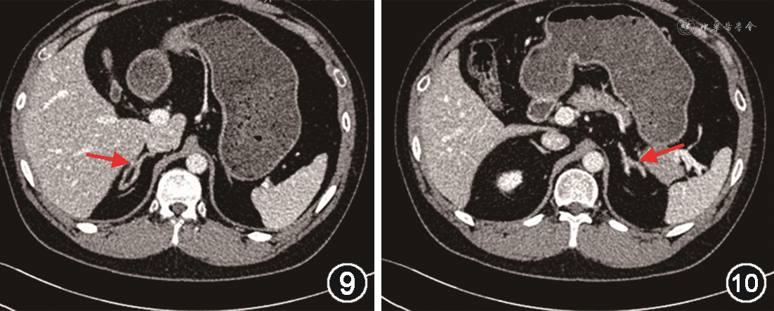 原发性色素沉着性结节性肾上腺皮质病3例 - 中华内科杂志