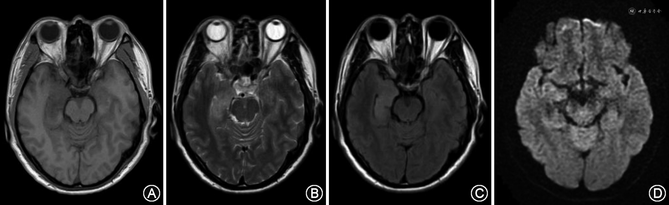 抗富亮氨酸胶质瘤失活1蛋白和抗髓鞘少突胶质细胞糖蛋白双抗体阳性的边缘叶脑炎1例 - 中华神经科杂志