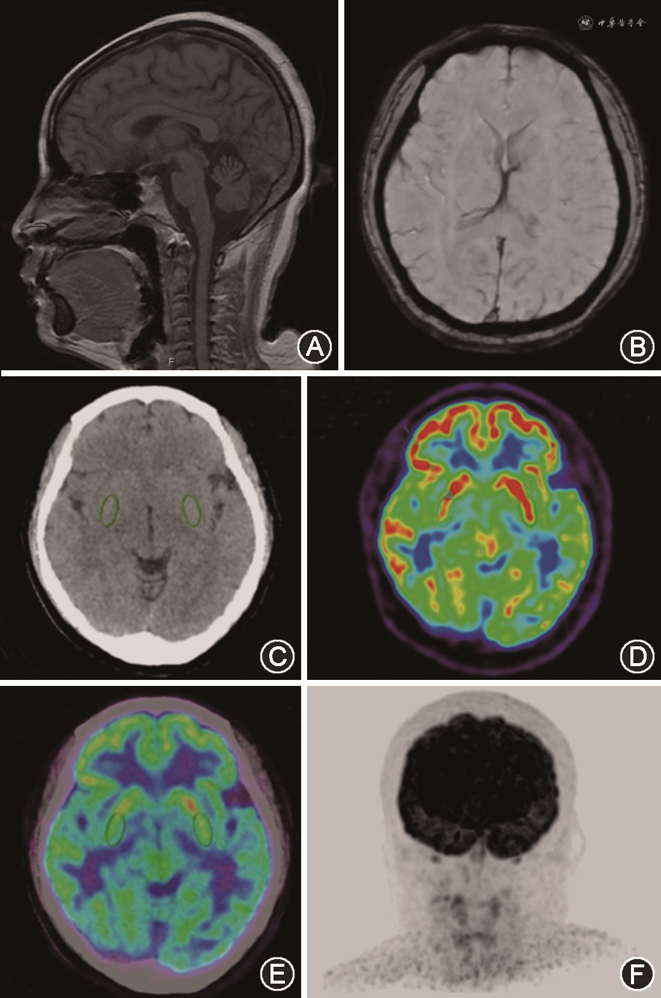 伴小脑萎缩的PLA2G6基因相关早发性帕金森综合征3例