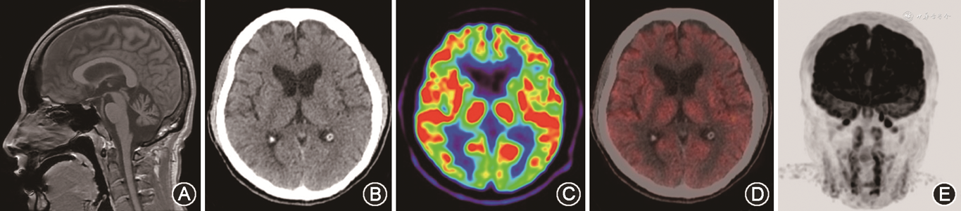 伴小脑萎缩的PLA2G6基因相关早发性帕金森综合征3例 - 中华神经科杂志